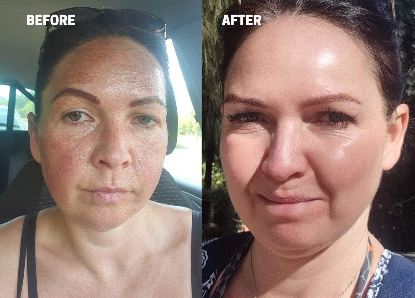 Fade Hyperpigmentation & Melasma | Dr Storm Skincare Solutions
